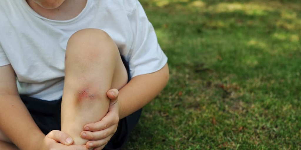 What are Bruises? Guide about Types of Bruises and Its Duration